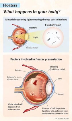 Floaters: Symptoms, causes, treatments, and natural approaches | Valley ...